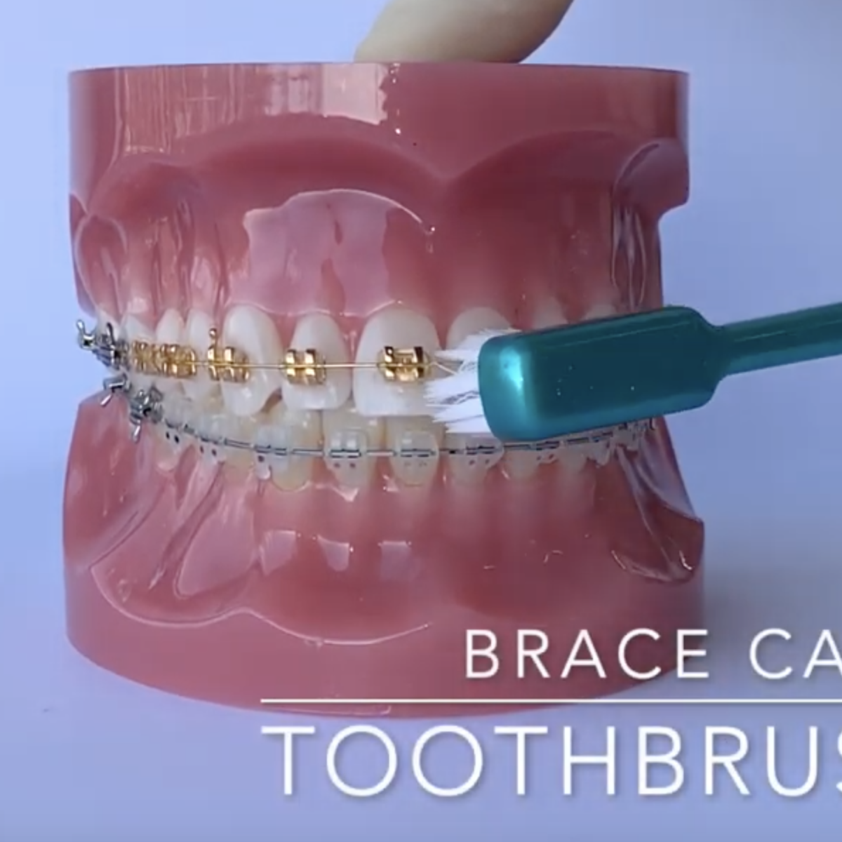 TOOTHBRUSHING FOR BRACES - the required method for brushing your brace ...