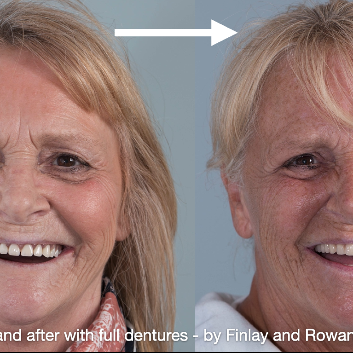 Lynne's complete (full) dentures by Finlay | Garstang Dental